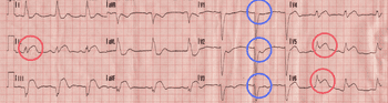 Sgarbossa Criteria | Nucleotype