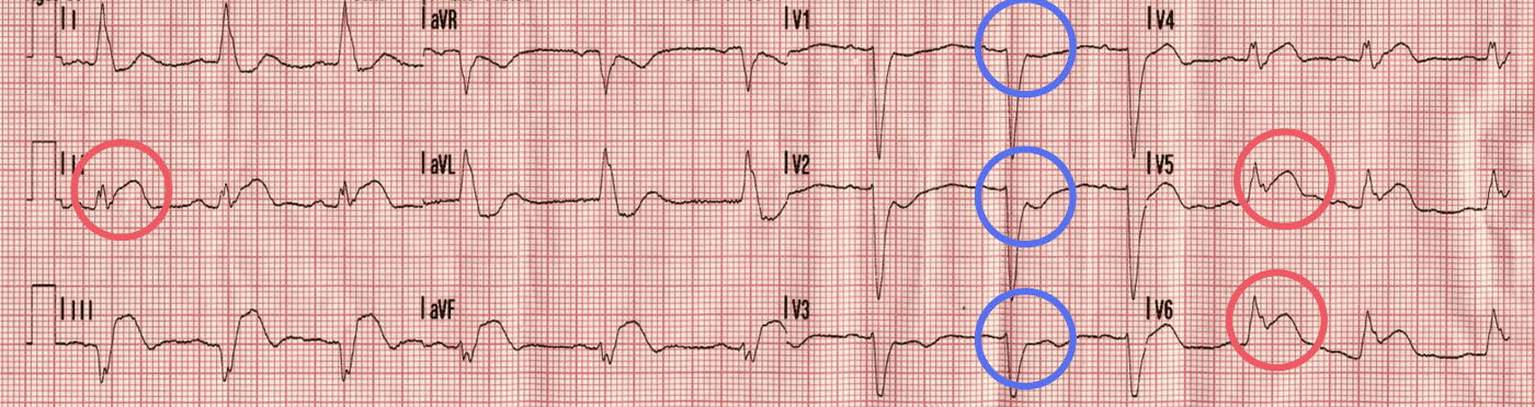 Sgarbossa Criteria | Nucleotype