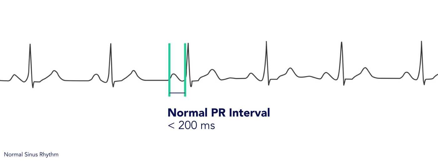 Mobitz Type I Versus Type II Second Degree Heart Block | Nucleotype
