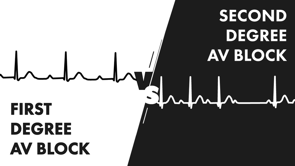 First Versus Second Degree Heart Block | Nucleotype