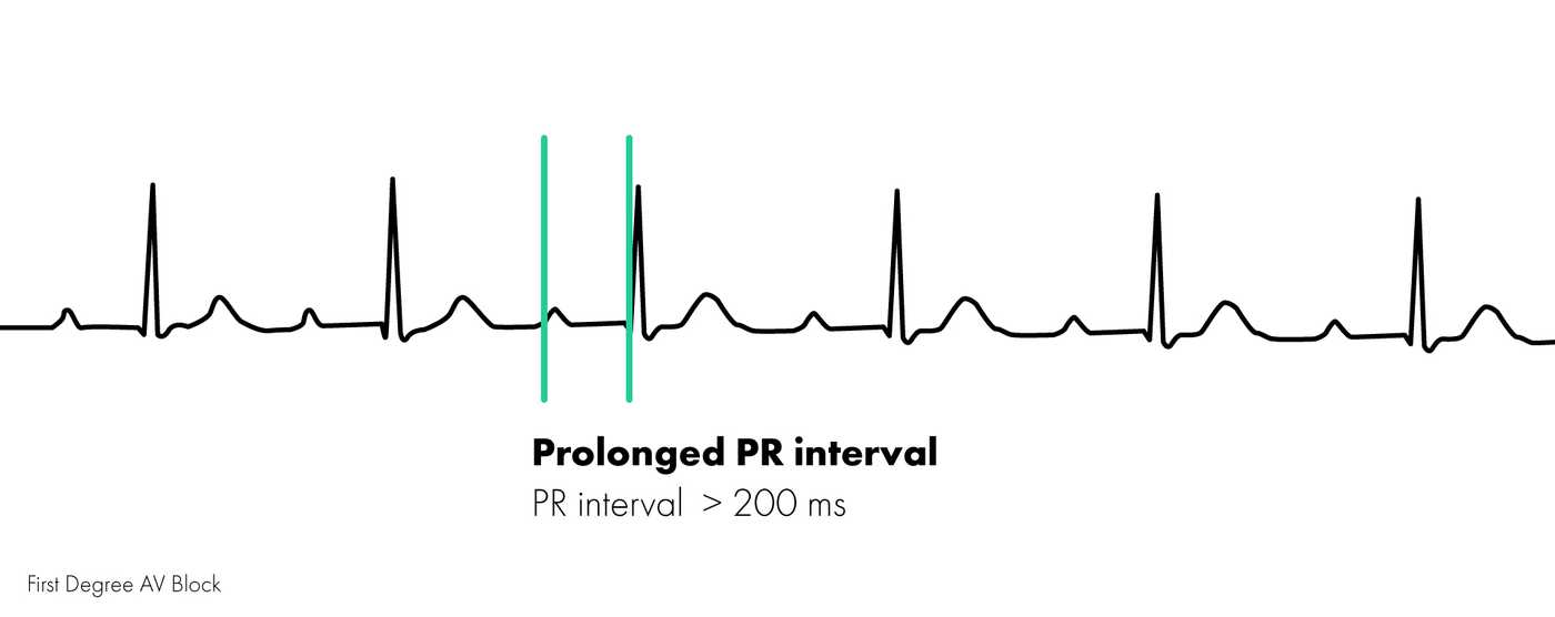 First Versus Second Degree Heart Block | Nucleotype