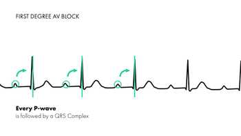 First Versus Second Degree Heart Block | Nucleotype