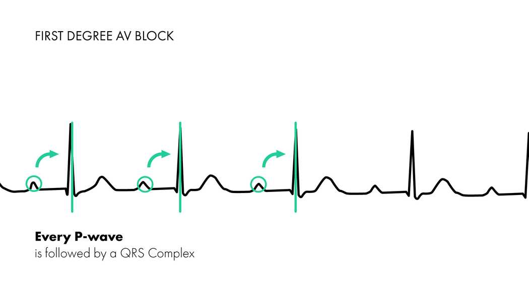 First Versus Second Degree Heart Block | Nucleotype